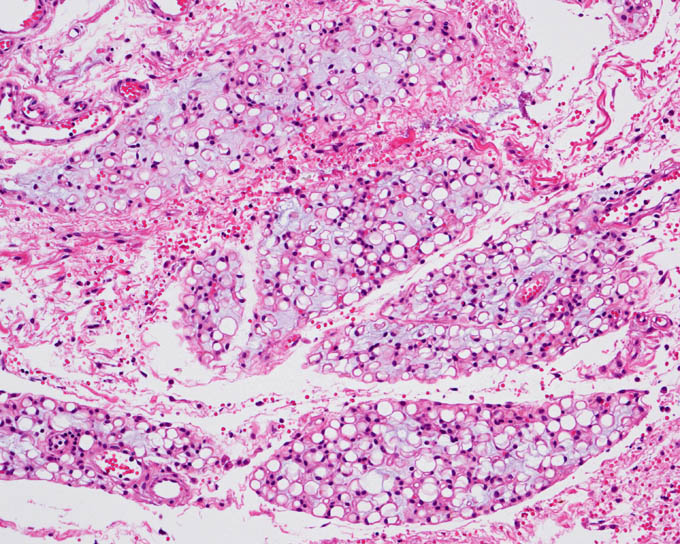 病理標本：脂肪，漿液性萎縮｜新潟大学医学部臨床病理学分野
